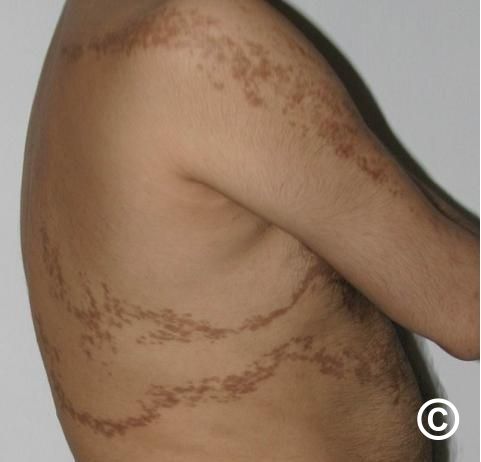 blaschkos-lines | Trendy Digests